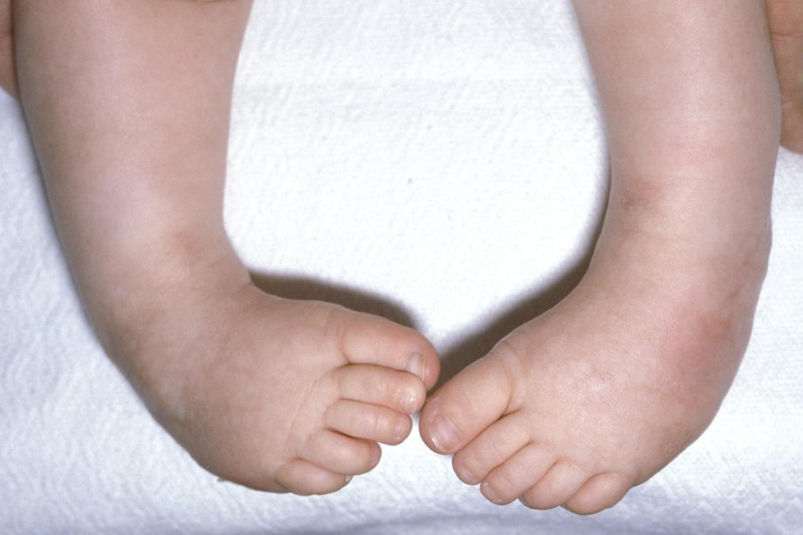 Clubfoot โรคเท้าปุก | สุขสาระ